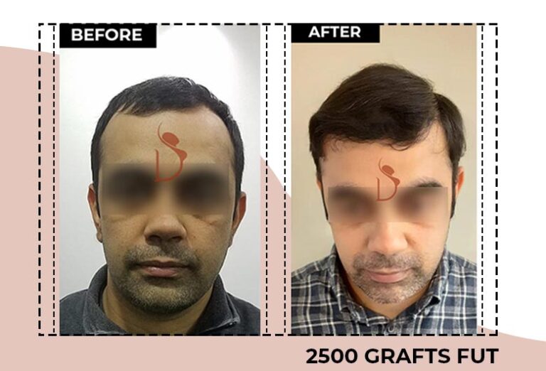 Best Hymenoplasty Surgery Cost in Delhi | Hymen Repair Surgery in Delhi