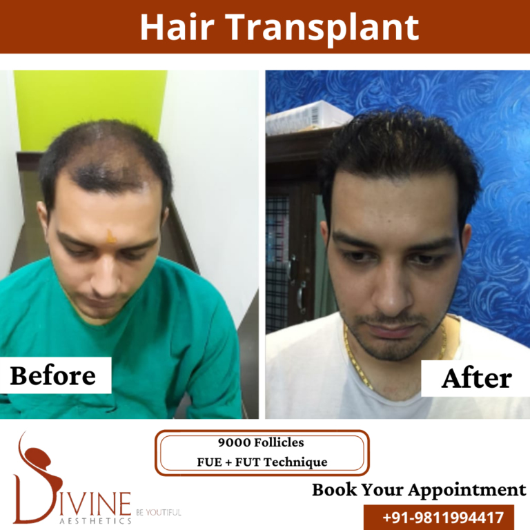 Micro Refined Microfollicular Hair Transplant | Affordable Hair Transplant