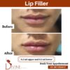 Lip Surgery Before and After | Results