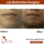 Lip Surgery Before and After | Results